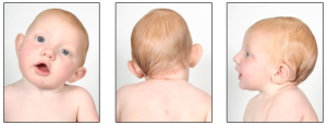 Torticollis/Plagiocephaly – Pediatric Therapy and Learning Center